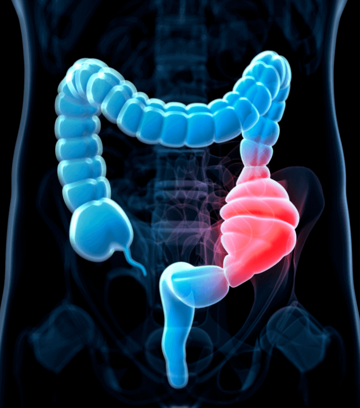 Stitichezza: Cause, Sintomi e Rimedi